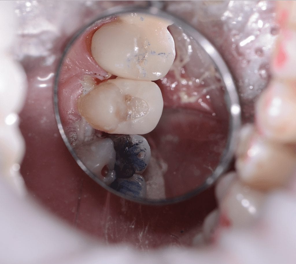 Premolar Onlay Captured in High Resolution Mode | CAD-Ray.com