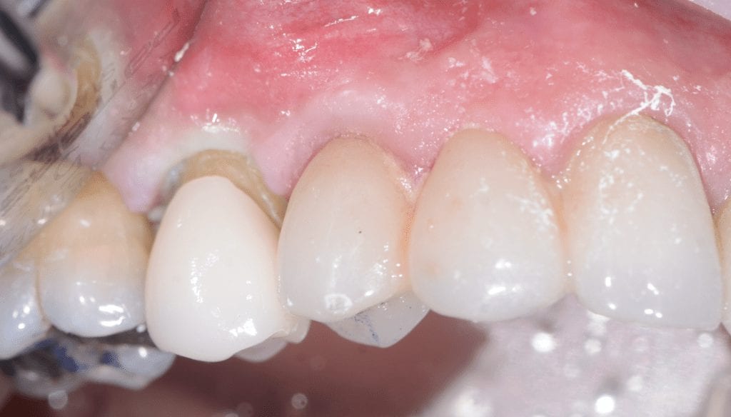 Premolar Onlay Captured in High Resolution Mode | CAD-Ray.com