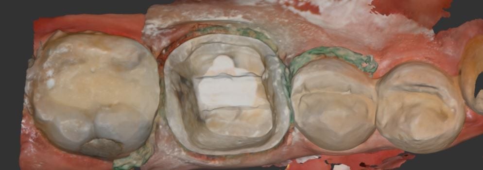 margins on first molar | CAD-Ray.com