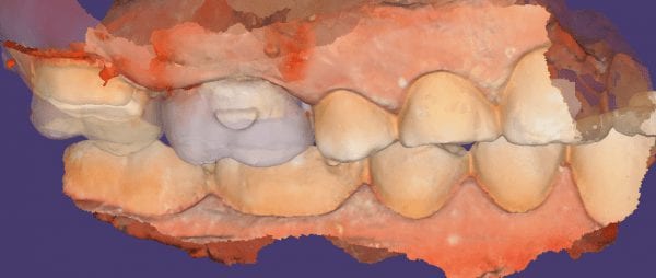 Three Ways to Tackle Adjacent Crowns | CAD-Ray.com