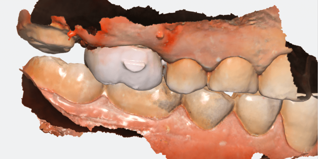 Three Ways to Tackle Adjacent Crowns | CAD-Ray.com