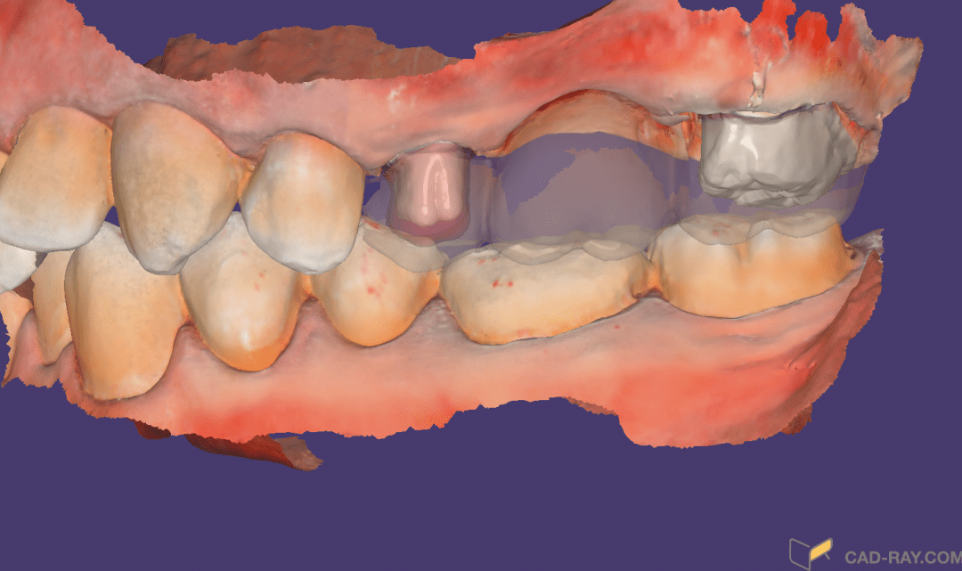 3 unit bridge | CAD-Ray.com