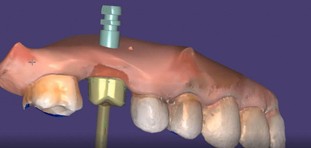 digital implant scanbody | CAD-Ray.com
