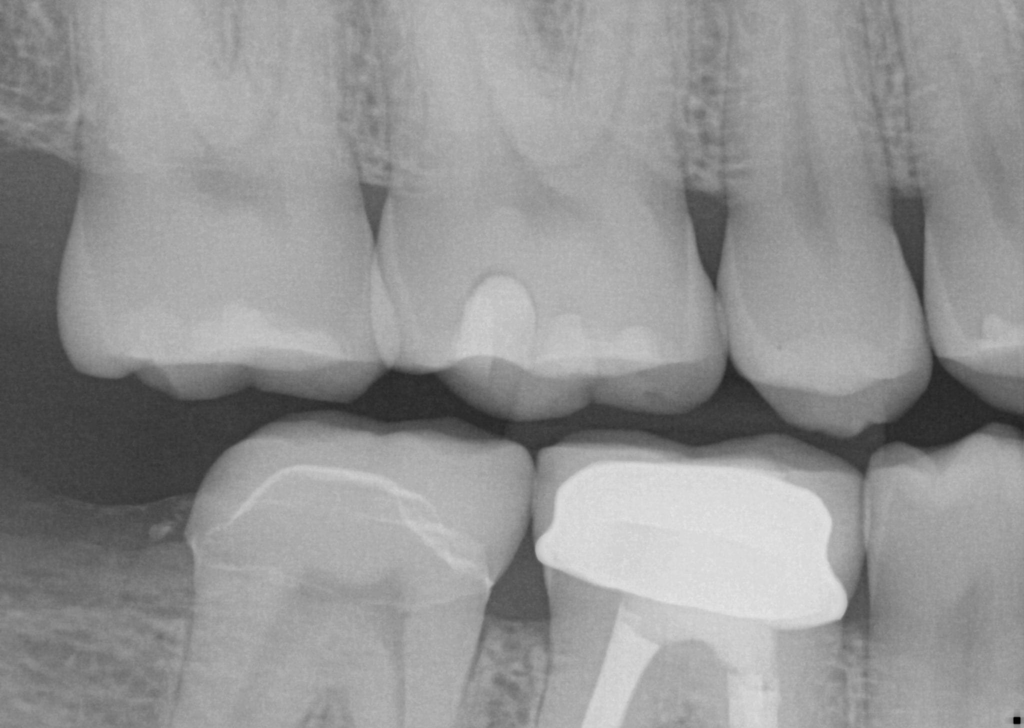 Second Molar Crown Replacement in Copy Mode | CAD-Ray.com