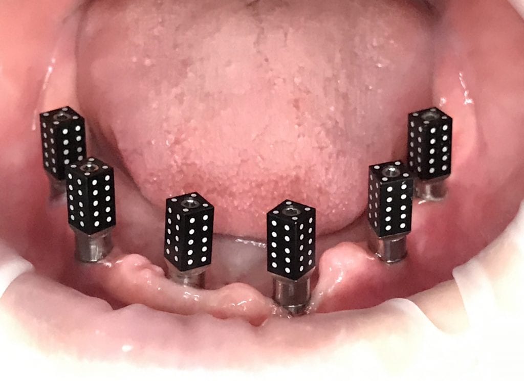 Photogrammetry and Intra-Oral Impressions | CAD-Ray.com