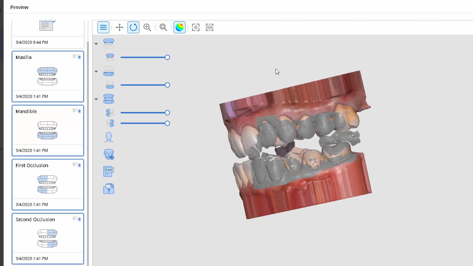 Mounting Upper and Lower Jaws for Obstructive Sleep Apnea Devices ...