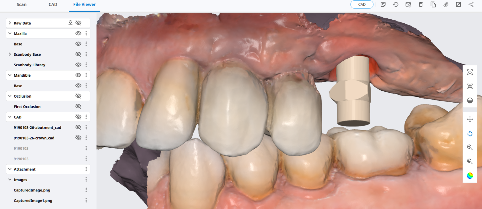 Overview of a Simple Scanbody Capture and Implant Abutment and Crown ...